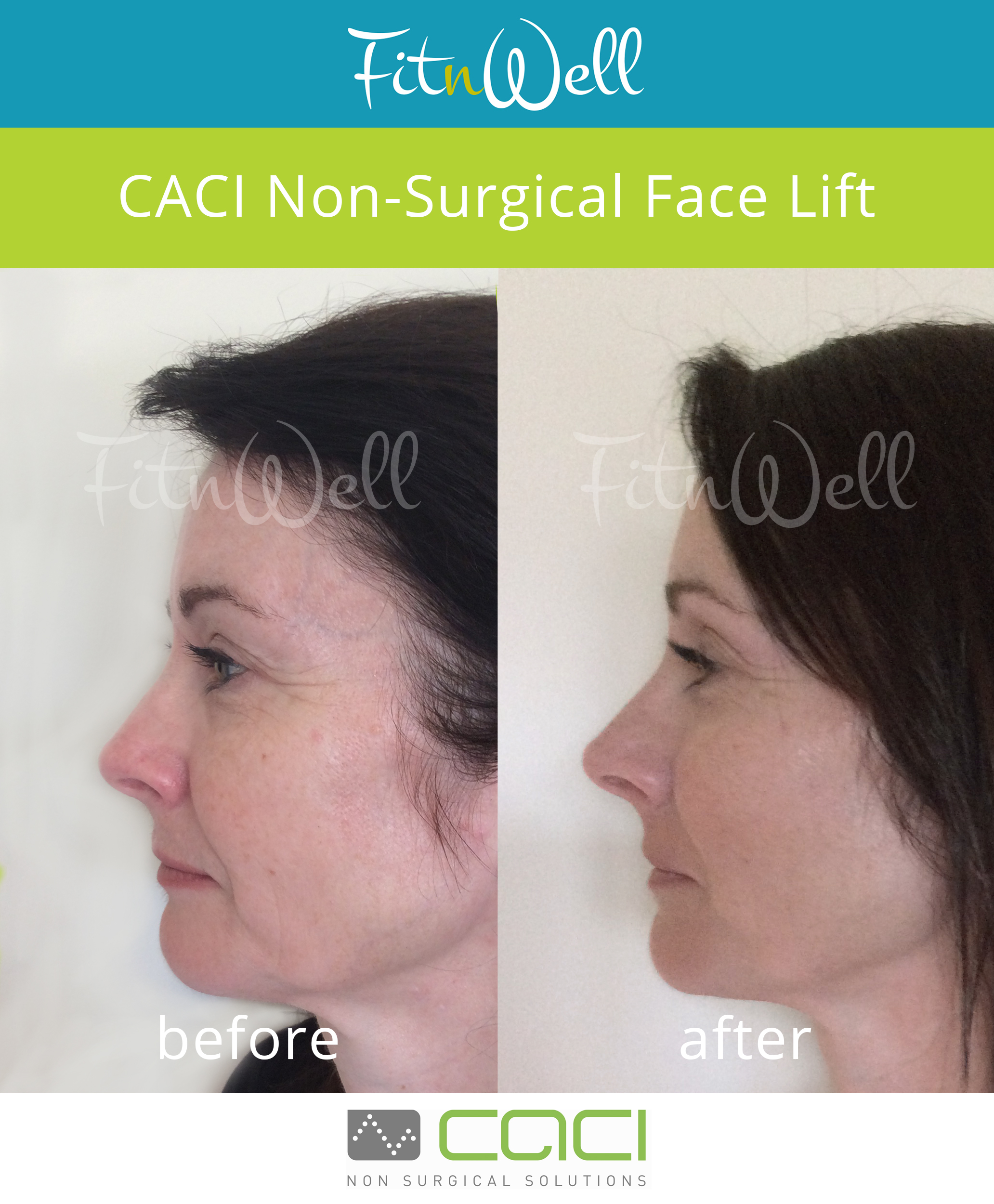CACI Non-Surgical Face Lift – Before and After | Fit n Well